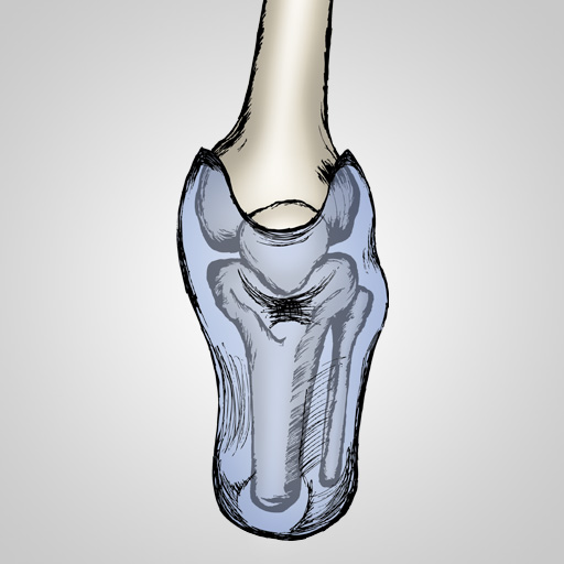 Transtibial - Socket Finder